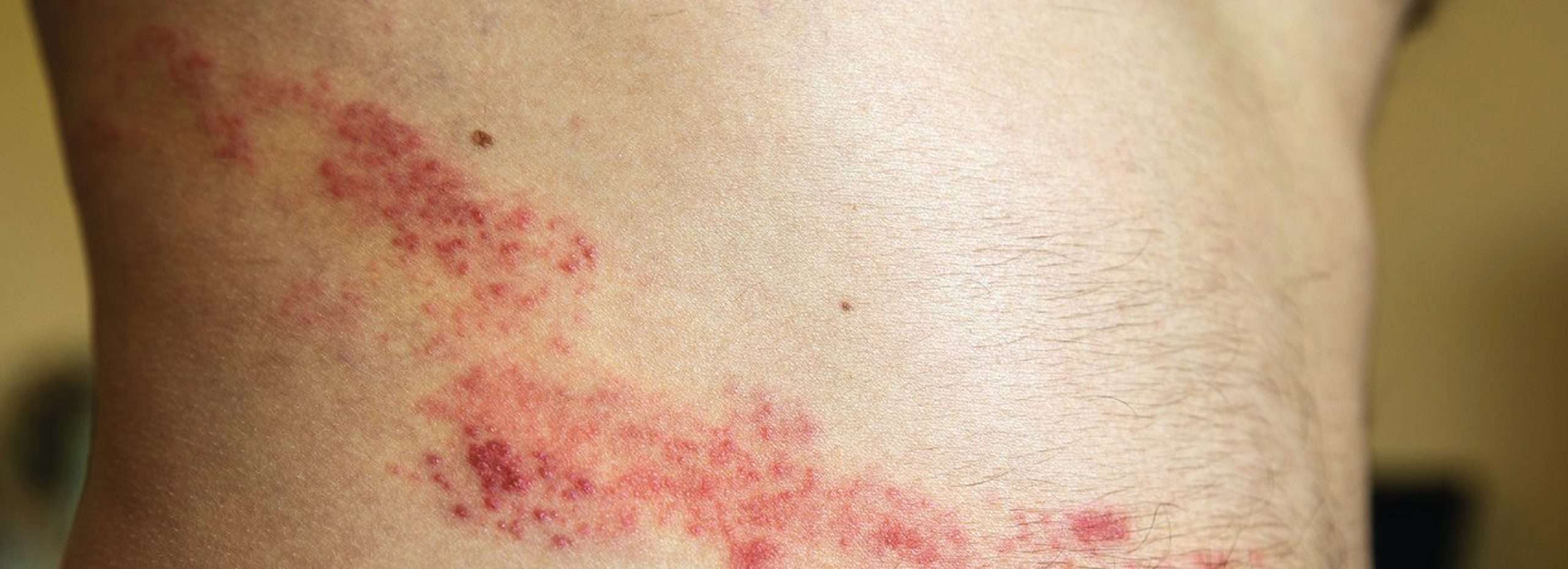 What is Shingles? - Sparkport Pharmacy